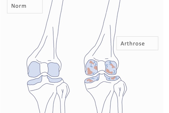 Gonarthrose – Physiotherapie & Osteopathie Beger | Leipzig Böhlitz-Ehrenberg